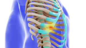 What is SRS | Slipping Rib Syndrome